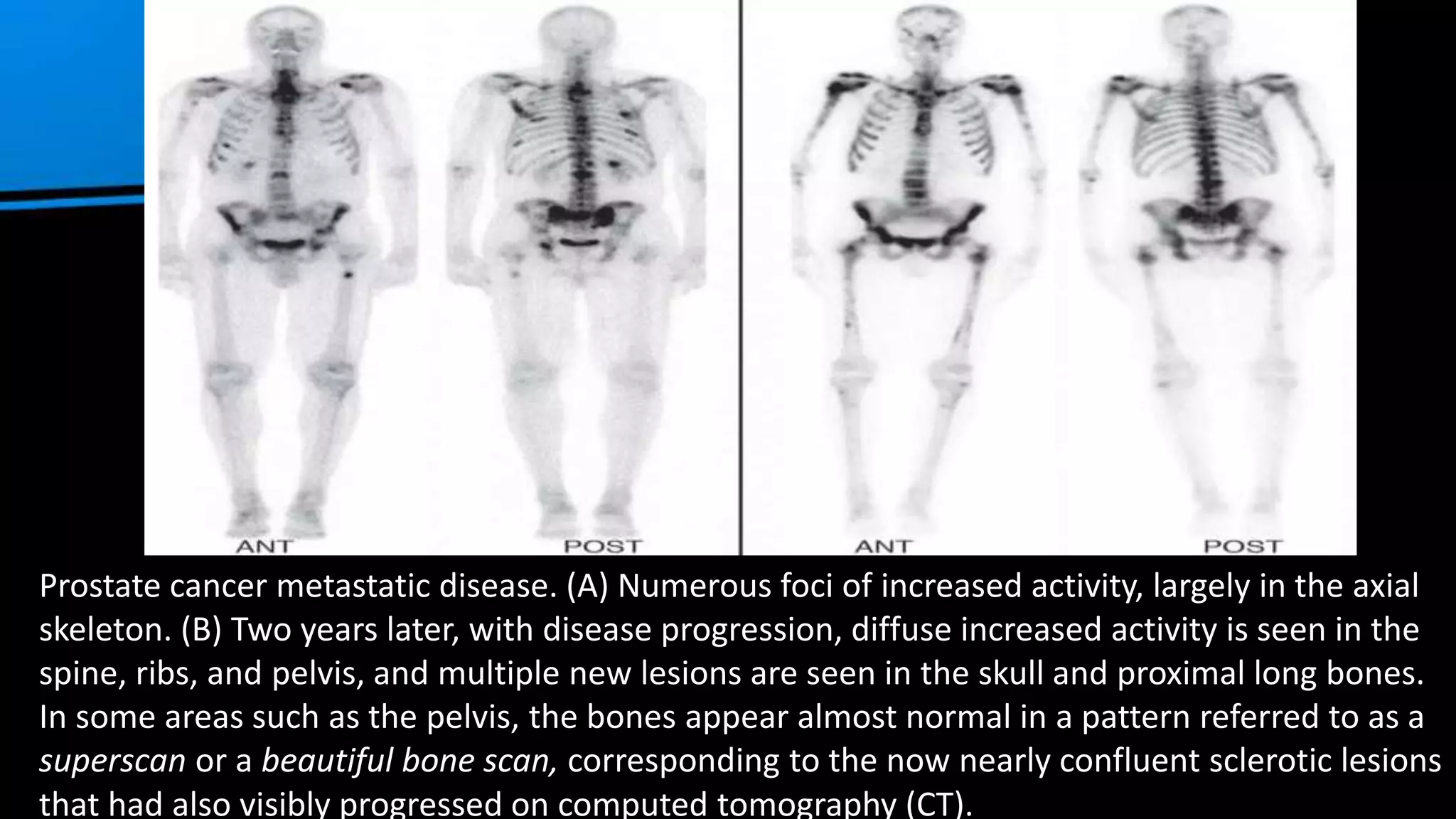 Skeletal scintigraphy presenatation, dr.mustafa | PPTX
