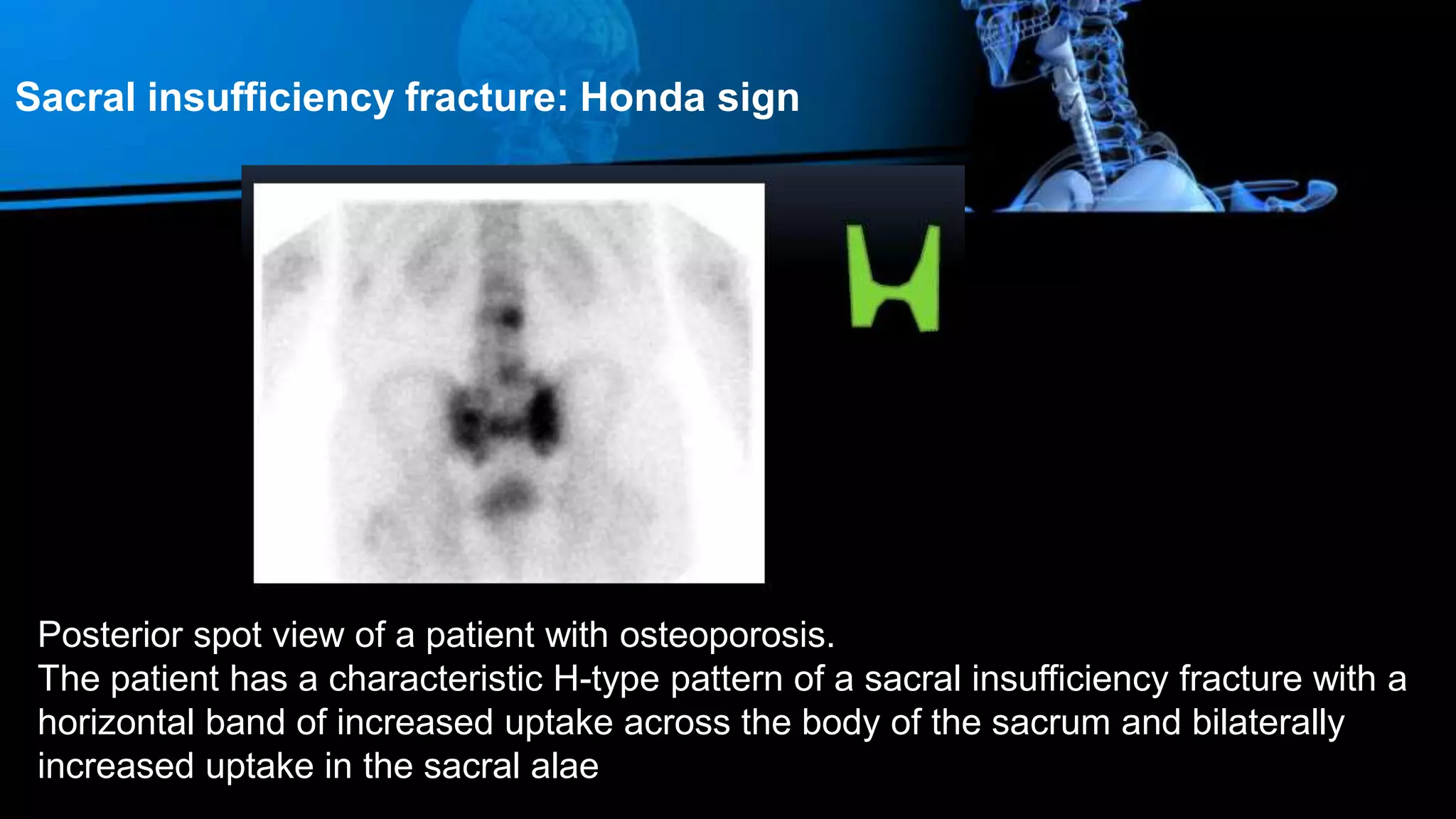 Skeletal scintigraphy presenatation, dr.mustafa | PPTX
