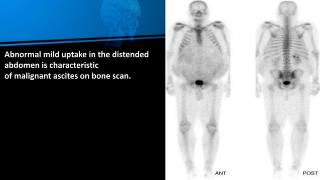 Skeletal scintigraphy presenatation, dr.mustafa | PPT