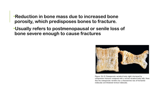 Disorders of bone .pptx