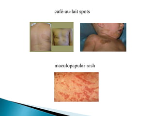 Cafe Au Lait Images Macular Rash