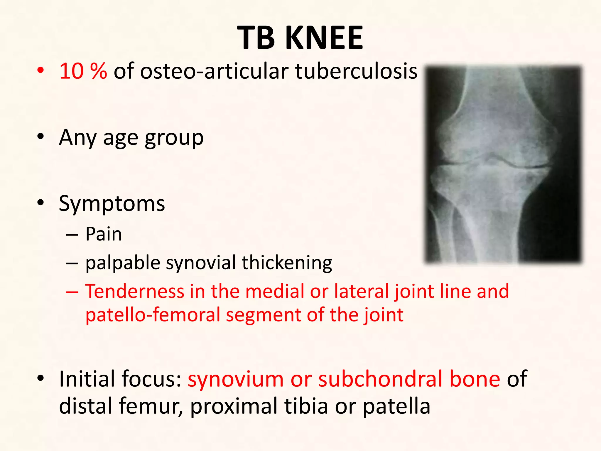 Skeletal tuberculosis | PPTX | Death, Injury, or Military Conflict ...