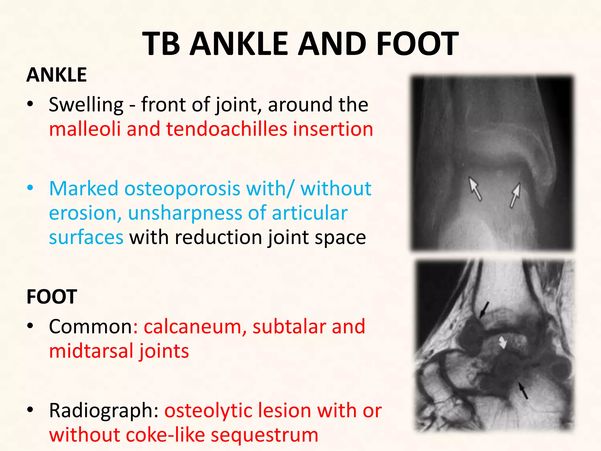 Skeletal tuberculosis | PPTX | Death, Injury, or Military Conflict ...