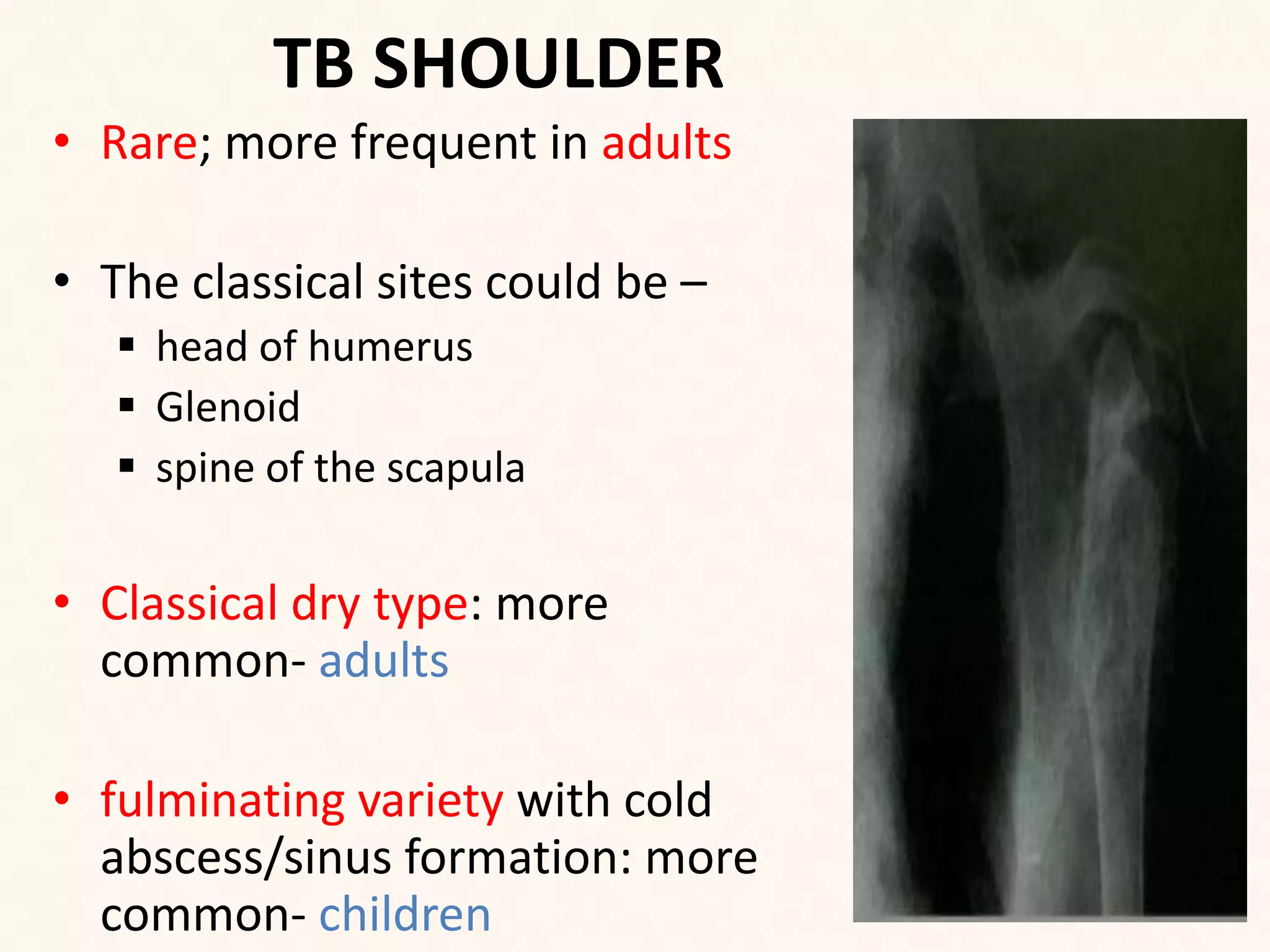 Skeletal tuberculosis | PPTX | Death, Injury, or Military Conflict ...