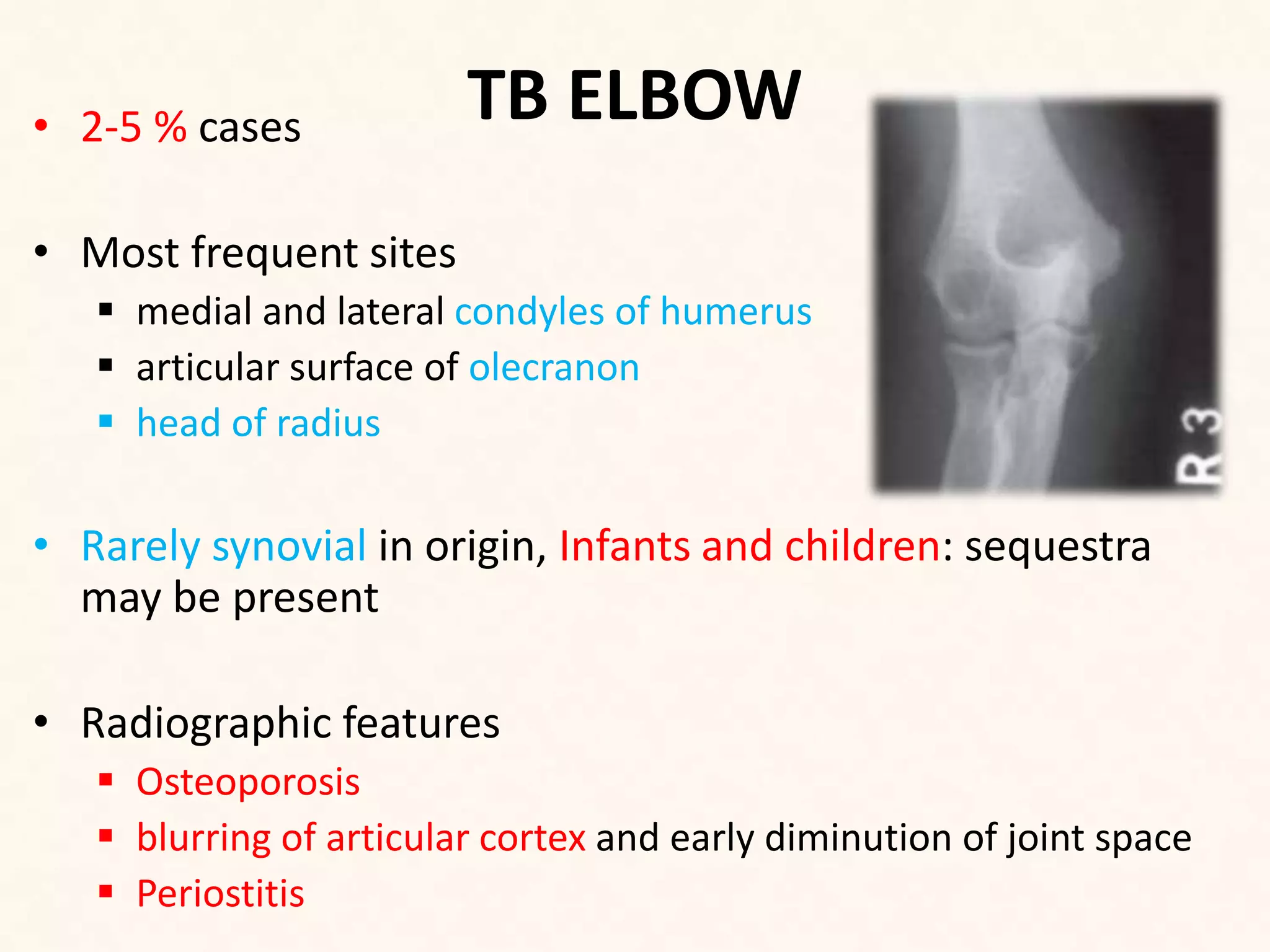 Skeletal tuberculosis | PPTX | Death, Injury, or Military Conflict ...