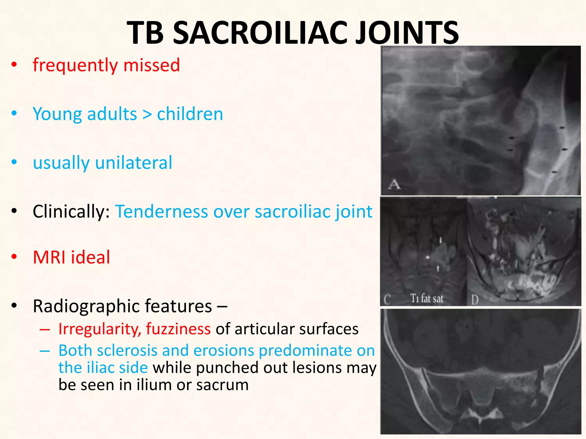 Skeletal tuberculosis | PPTX | Death, Injury, or Military Conflict ...