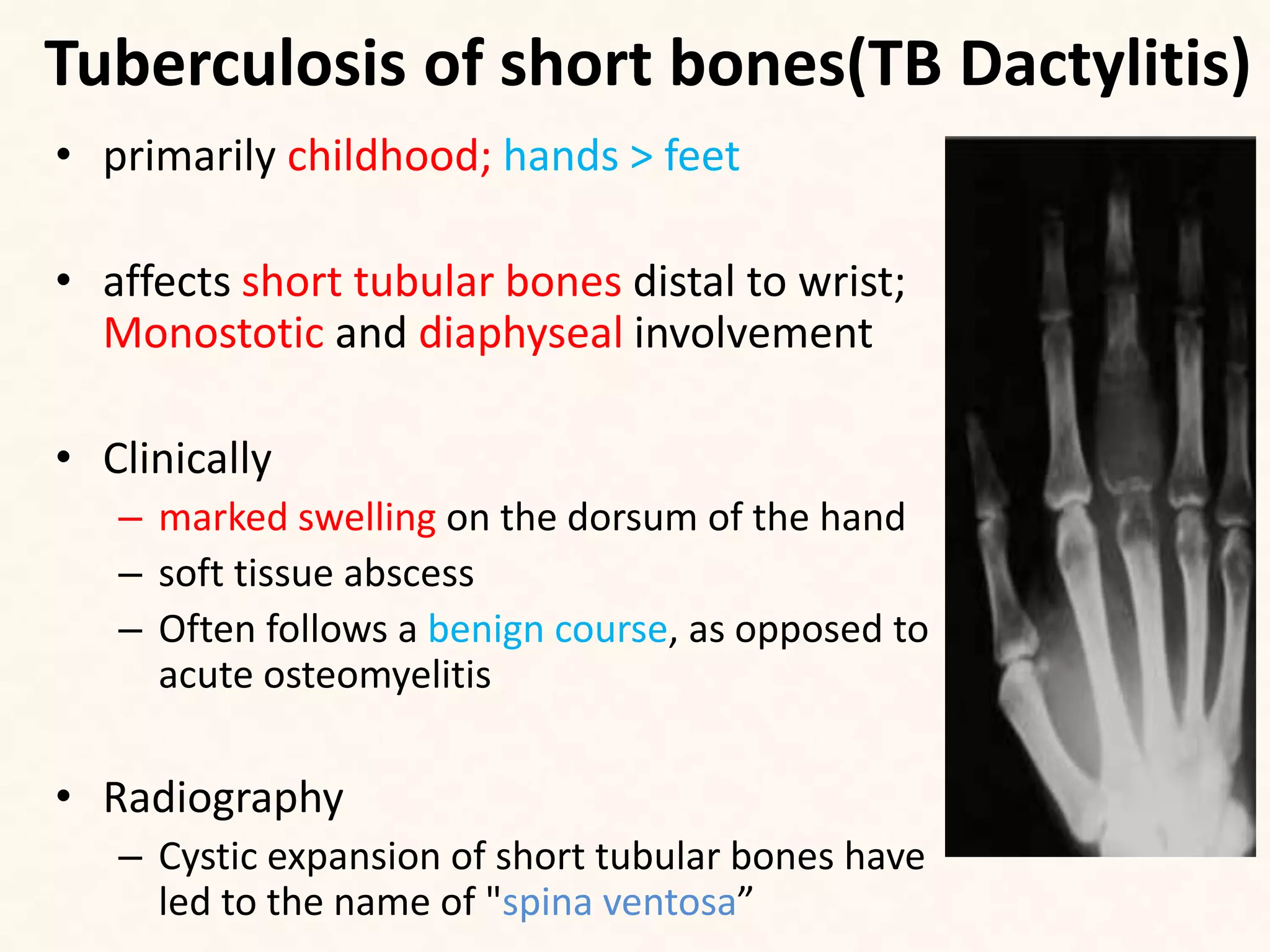 Skeletal tuberculosis | PPTX | Death, Injury, or Military Conflict ...