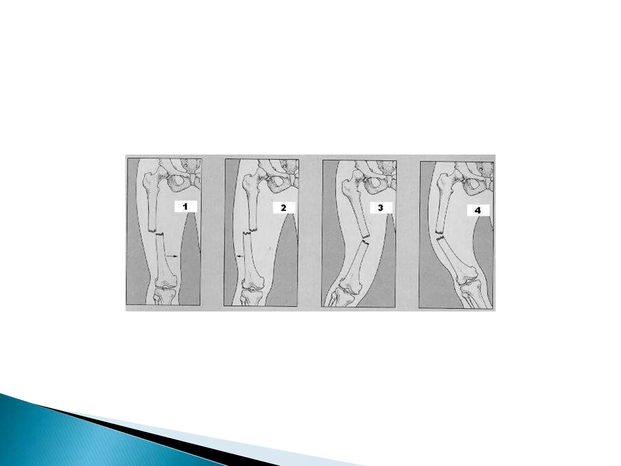 Skeletal trauma | PPT