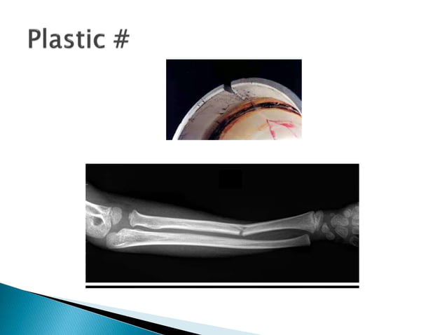 Skeletal trauma | PPT