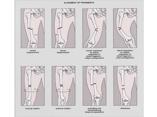imaging in skeletal trauma.ppt | Death, Injury, or Military Conflict ...
