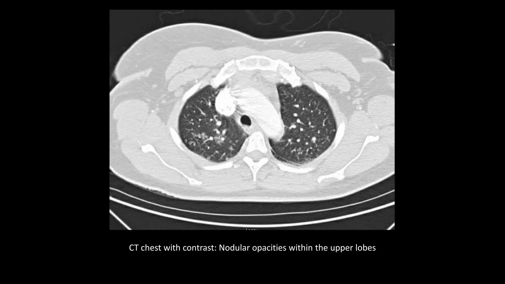 Skeletal Tuberculosis | PPTX