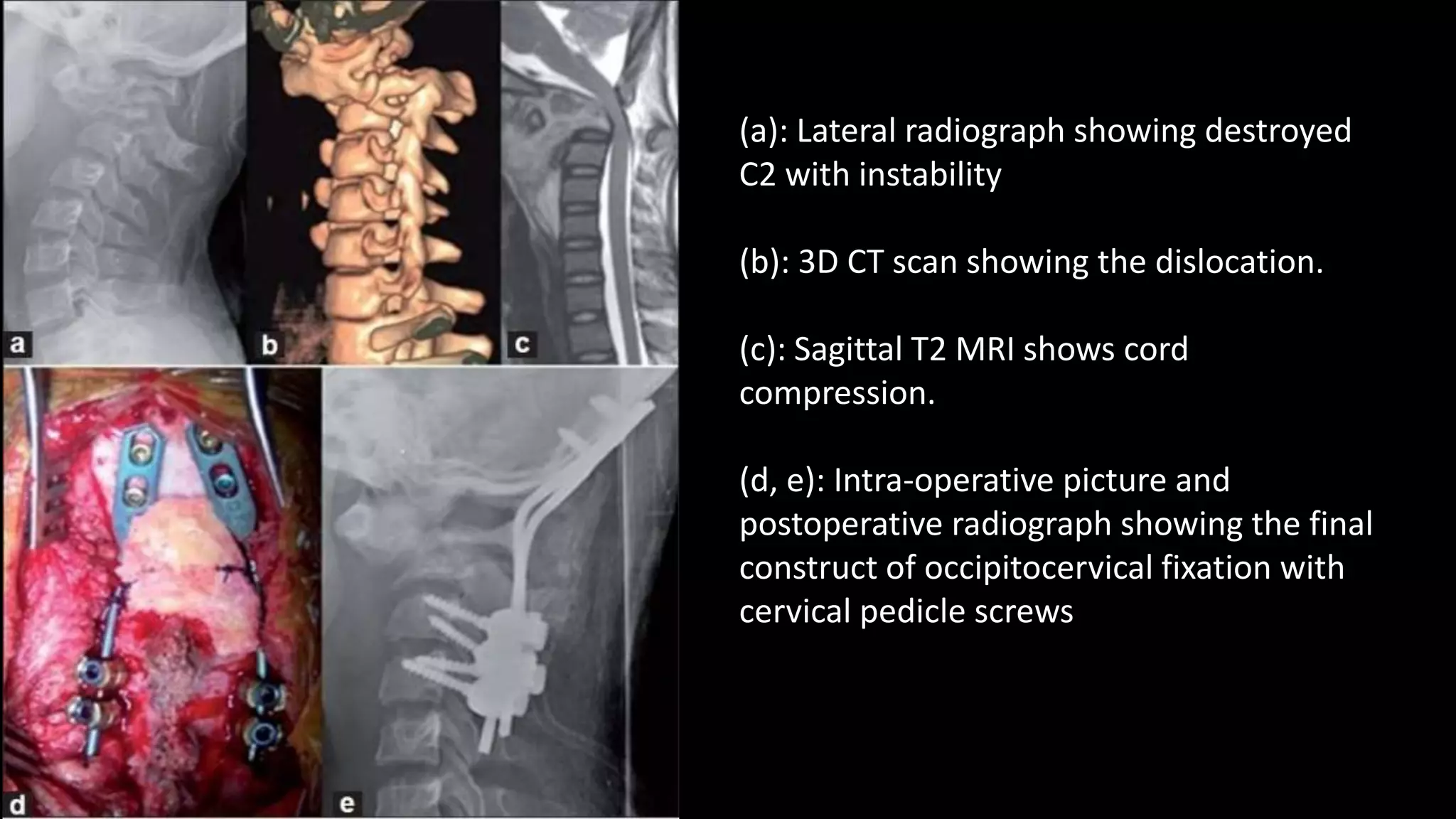 Skeletal Tuberculosis | PPTX