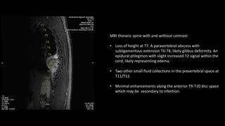 Skeletal Tuberculosis | PPTX