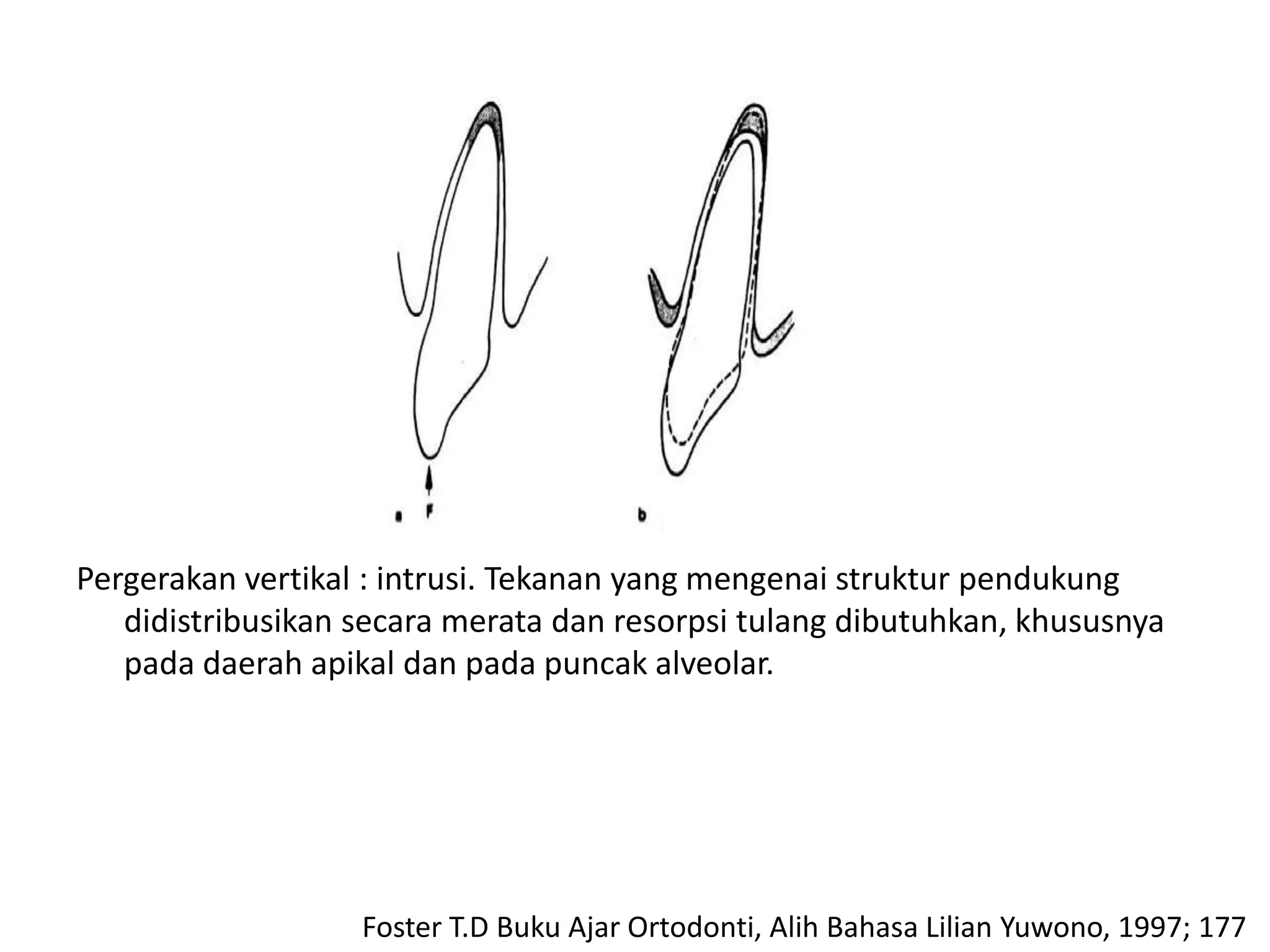 biomekanika pergerakan gigi | PPTX
