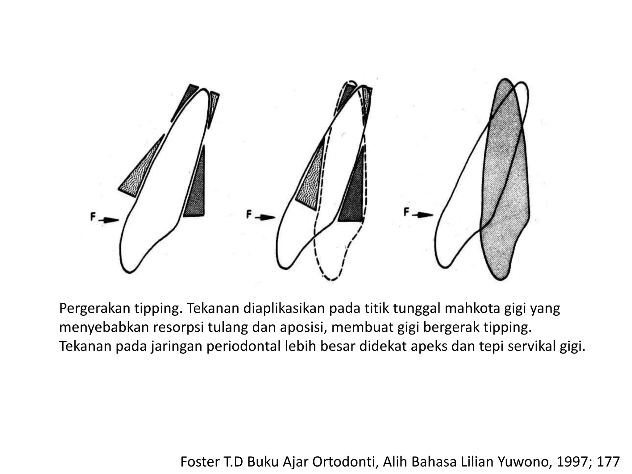 biomekanika pergerakan gigi | PPTX