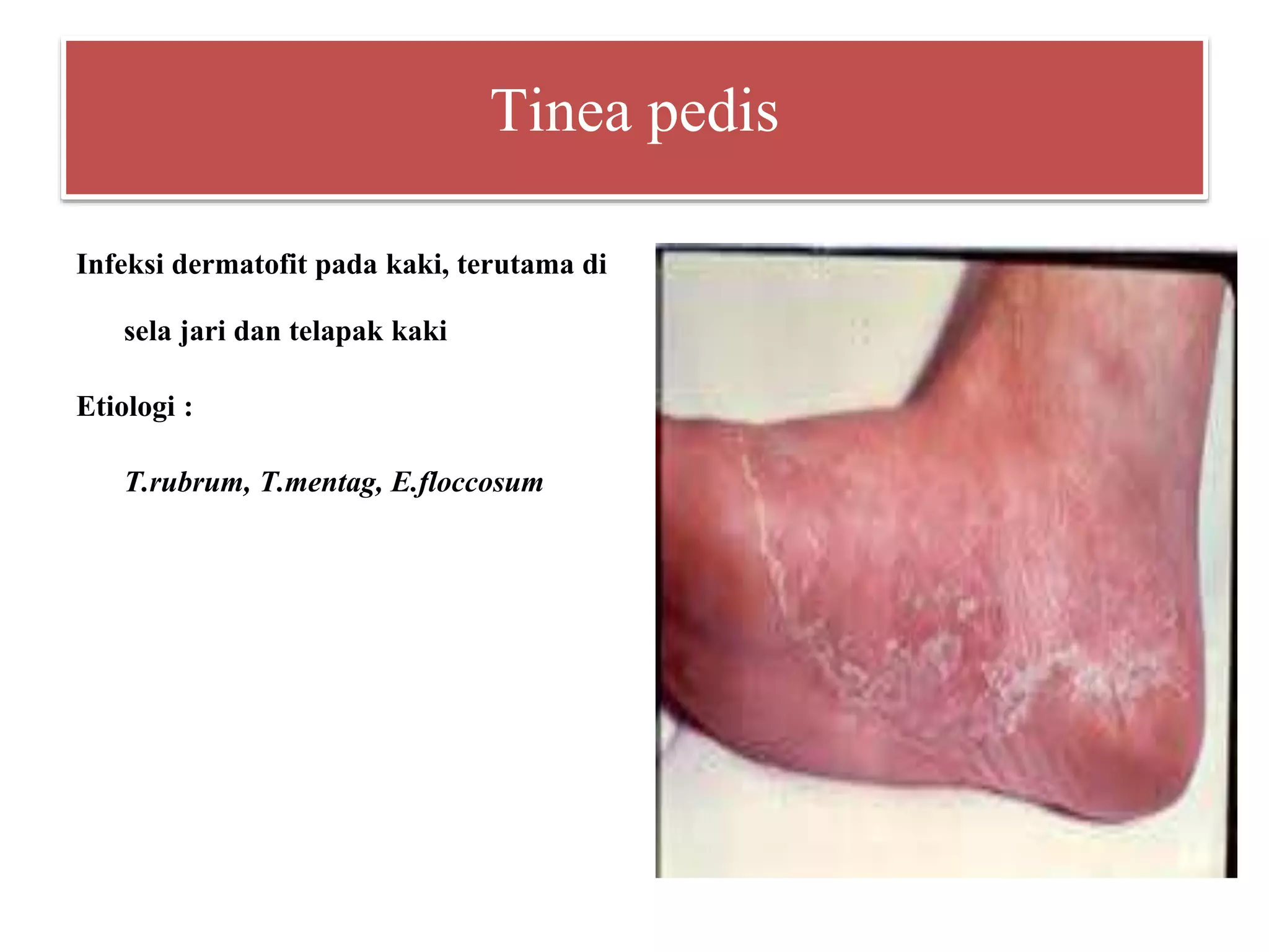 Skenario 20.5 Dermatofitosis & Non-dermatofitosis | PPTX