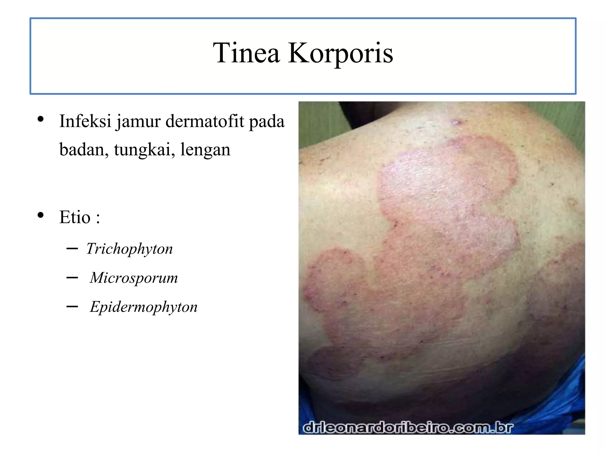 Skenario 20.5 Dermatofitosis & Non-dermatofitosis | PPTX