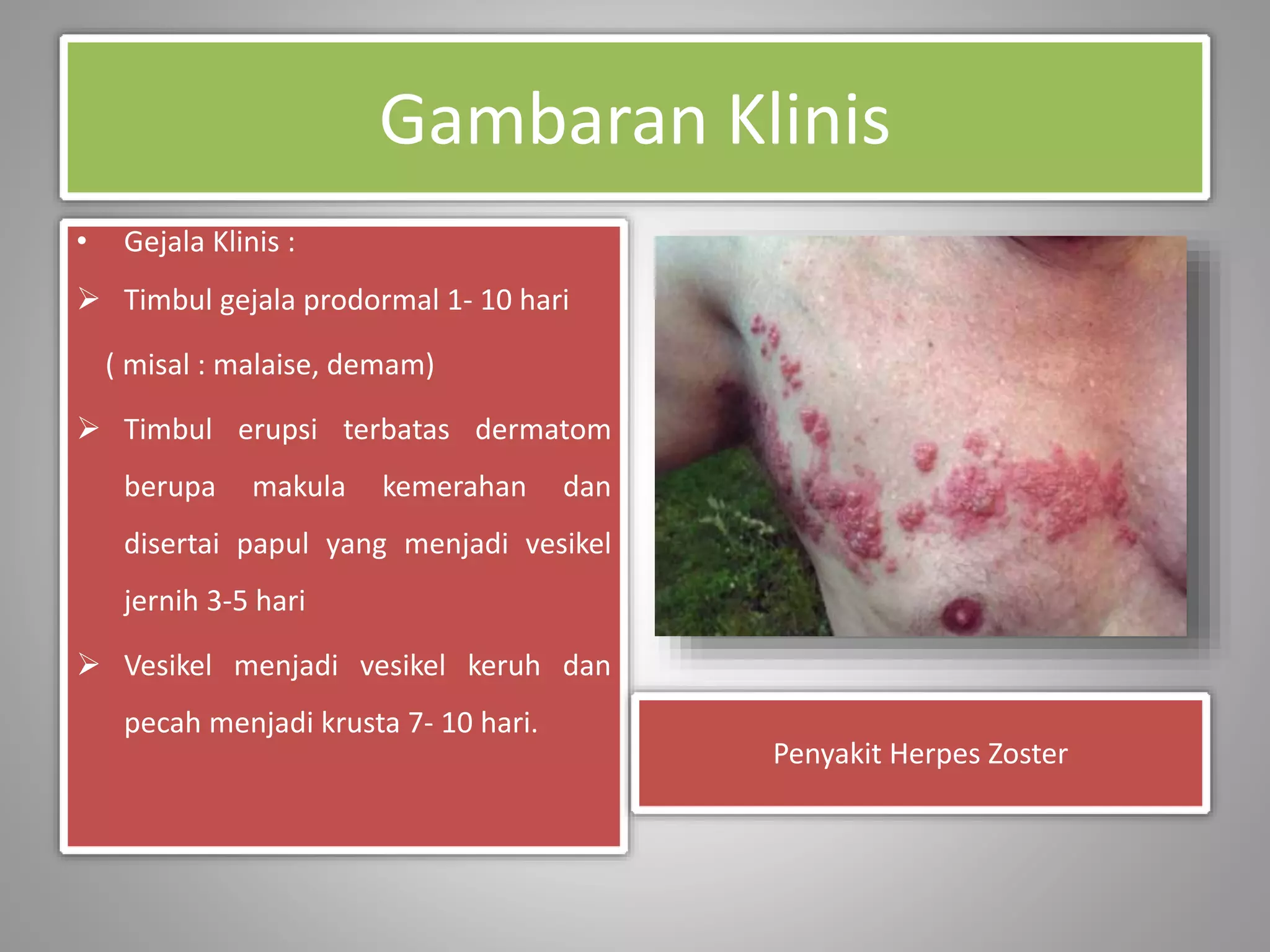 CUTANEUS LARVA MIGRAN / CREEPING ERUPTION | PPTX
