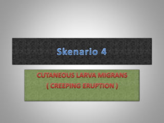 CUTANEUS LARVA MIGRAN / CREEPING ERUPTION | PPTX