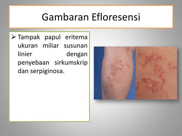 CUTANEUS LARVA MIGRAN / CREEPING ERUPTION | PPTX