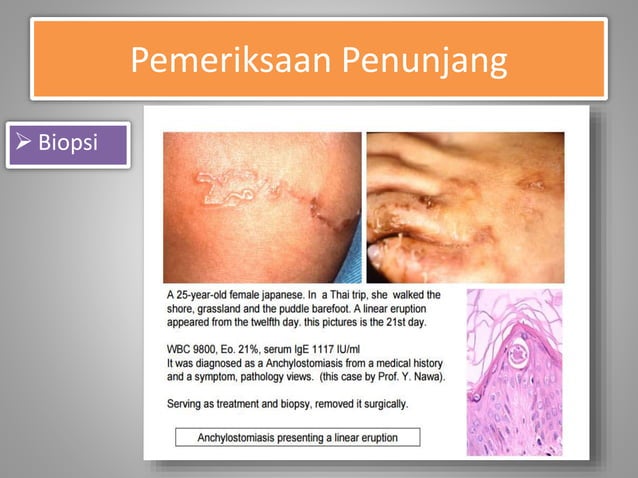 CUTANEUS LARVA MIGRAN / CREEPING ERUPTION | PPTX