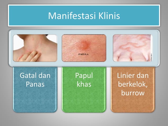 CUTANEUS LARVA MIGRAN / CREEPING ERUPTION | PPTX