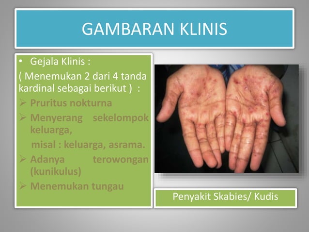 CUTANEUS LARVA MIGRAN / CREEPING ERUPTION | PPT