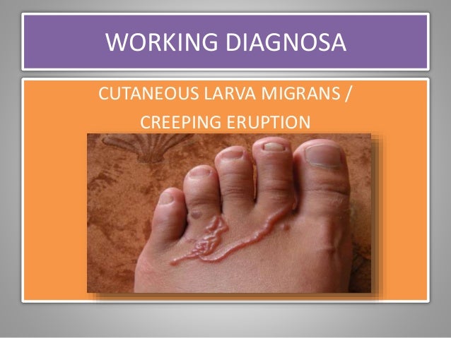 Cutaneous Larva Migrans Right