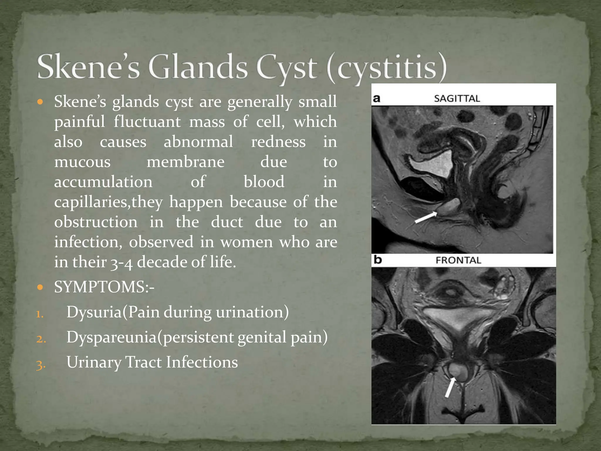 Skene’s gland anatomy and regulations and features | PPTX