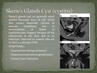 Skene’s gland anatomy and regulations and features | PPTX