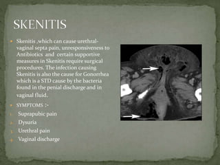 Skene’s gland anatomy and regulations and features | PPTX