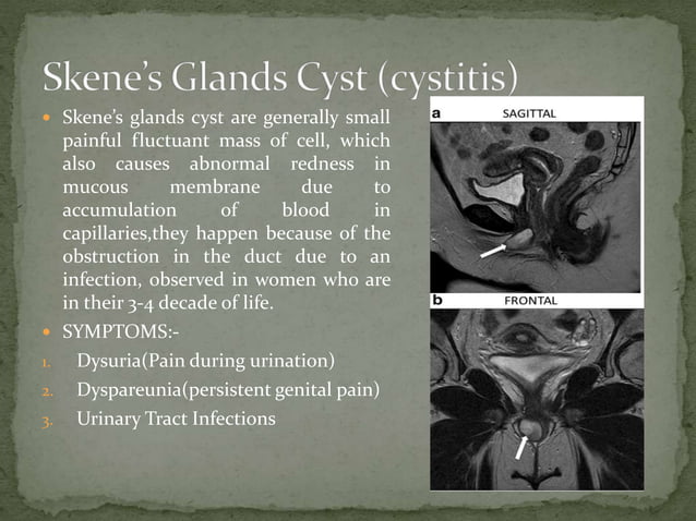 Skene’s gland anatomy features and functions | PPTX
