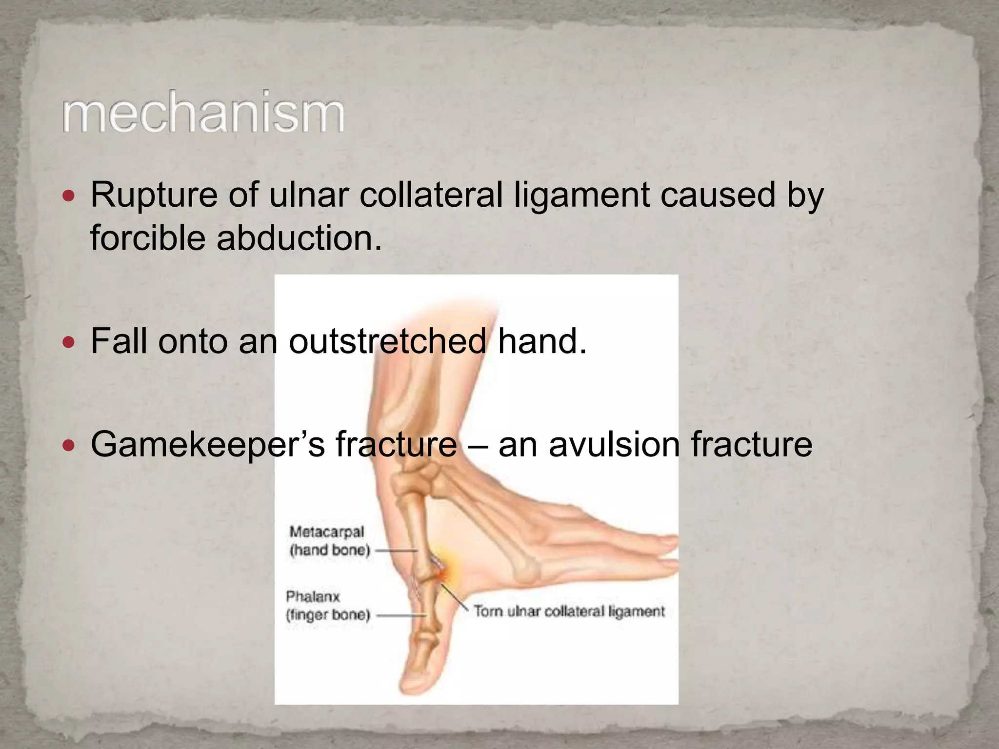 Skier’s thumb | PPTX