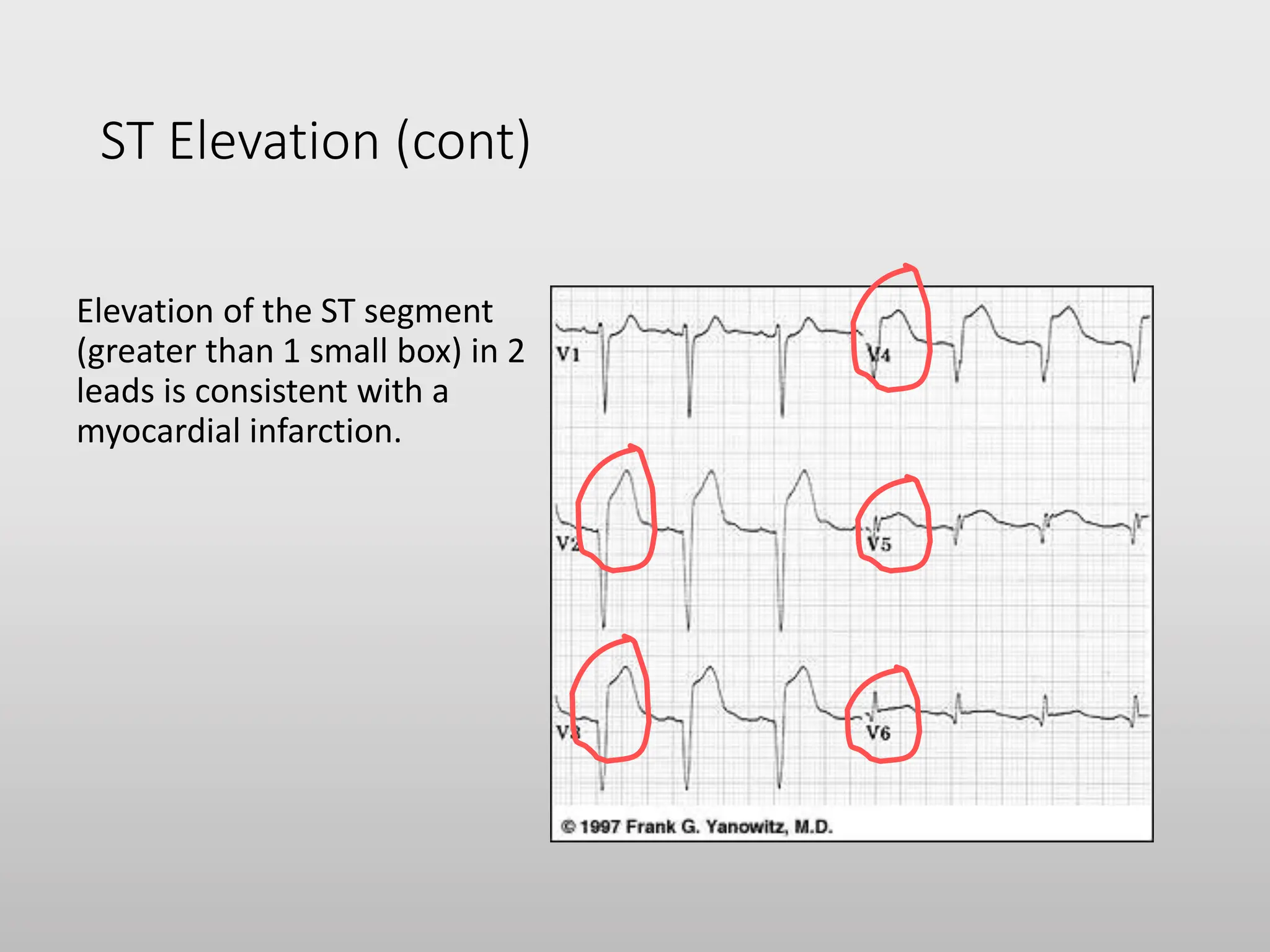 Skill ECG (1) Ischemia for students .pptx