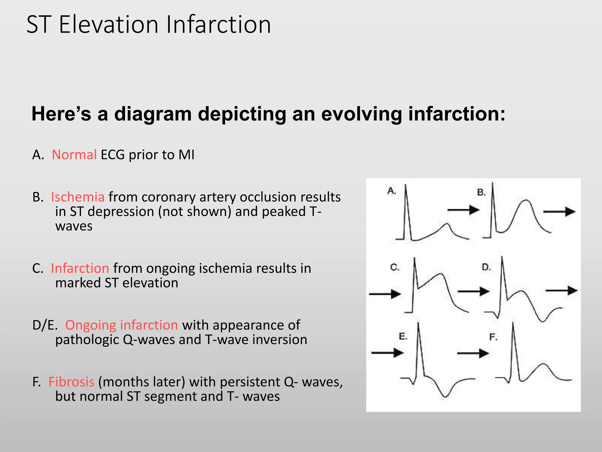 Skill ECG (1) Ischemia for students .pptx