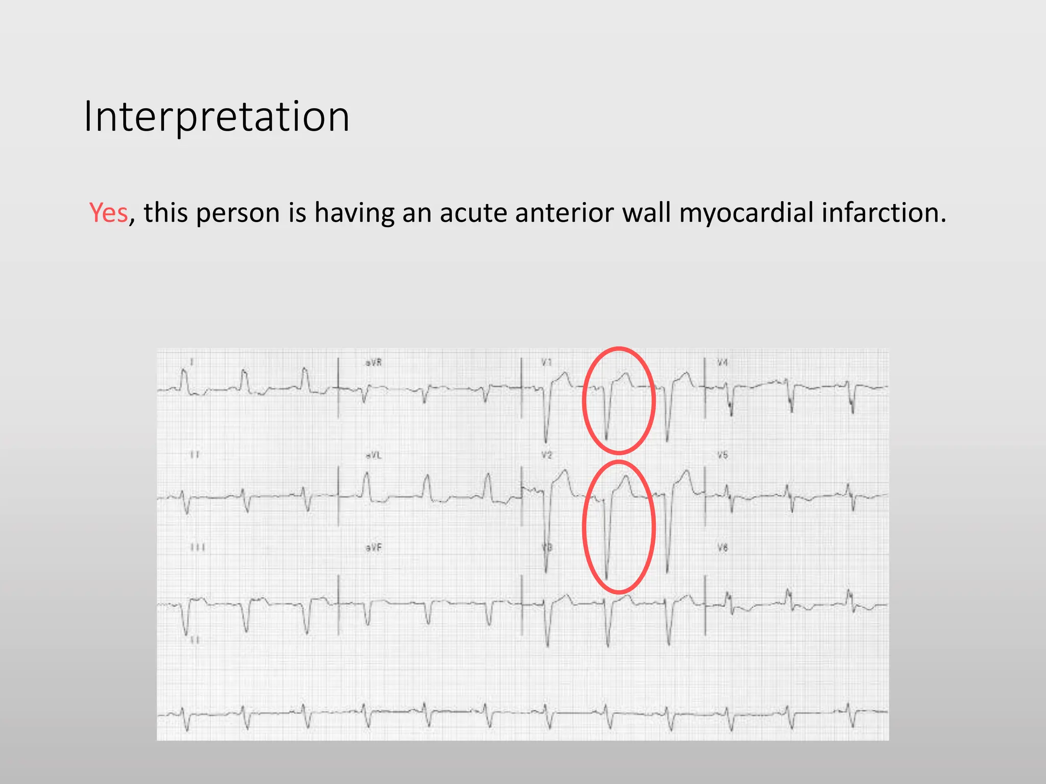Skill ECG (1) Ischemia for students .pptx