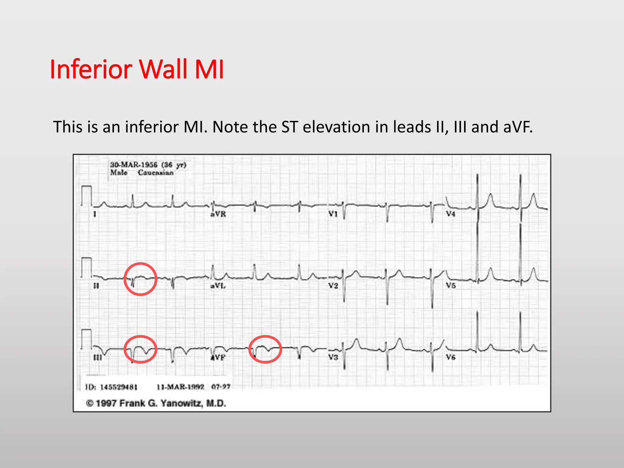 Skill ECG (1) Ischemia for students .pptx
