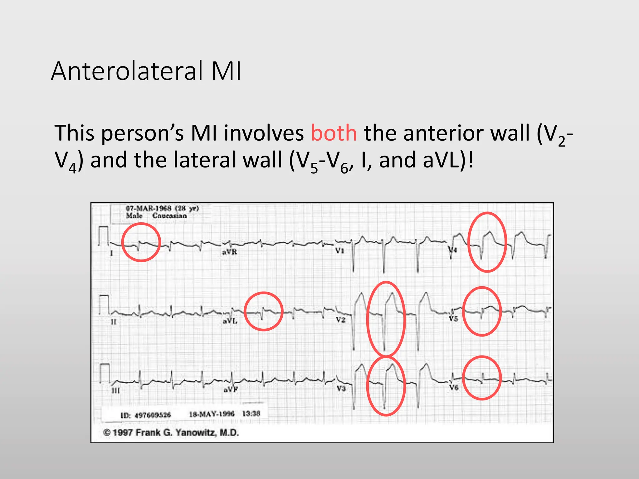 Skill ECG (1) Ischemia for students .pptx