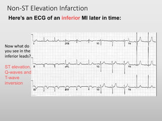 Skill ECG (1) Ischemia for students .pptx