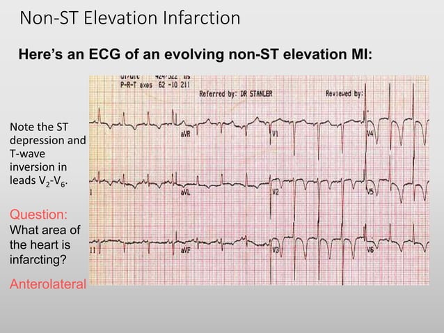 Skill ECG (1) Ischemia for students .pptx