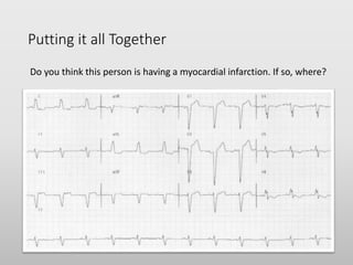 Skill ECG (1) Ischemia for students .pptx