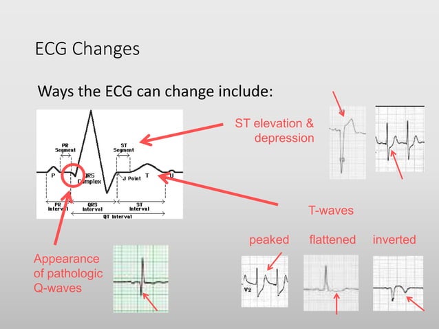 Skill ECG (1) Ischemia for students .pptx