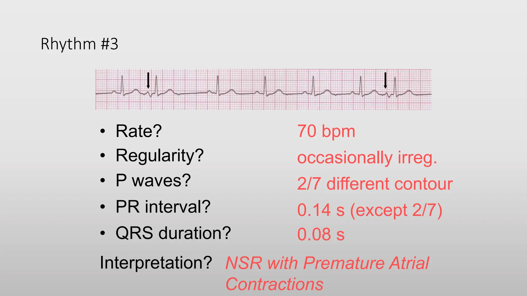 Skill ECG (2) arrhythmia for students.pptx