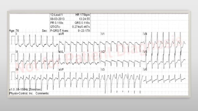Skill ECG (2) arrhythmia for students.pptx
