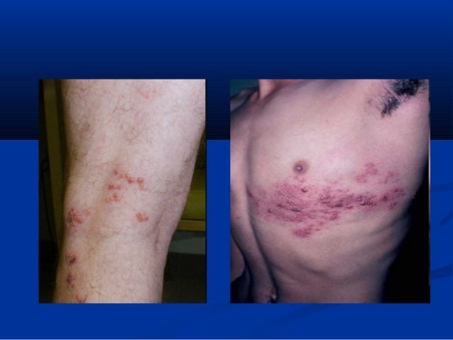 common Skin infections | PPT | Infectious Diseases | Diseases and ...