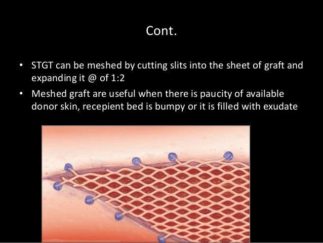 Skin Graft