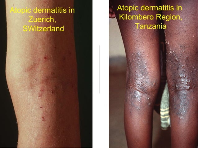 Allergic skin diseases in tropical areas | PPT