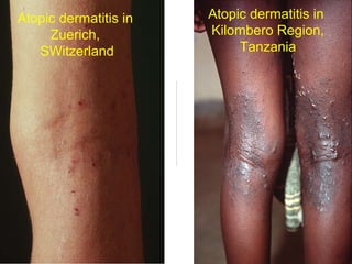 Tropical Skin Fungus