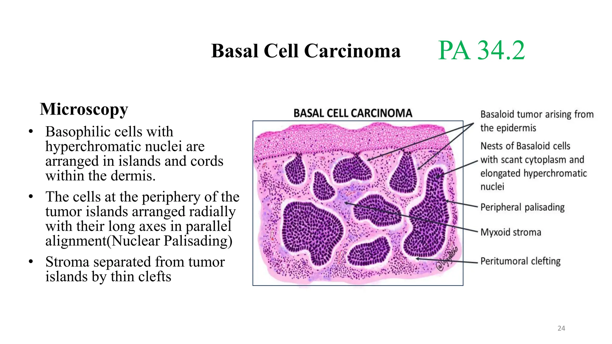 Skin ( basal cell carcinoma, malignant melanoma etc.) | PDF