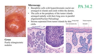 Skin ( basal cell carcinoma, malignant melanoma etc.) | PDF